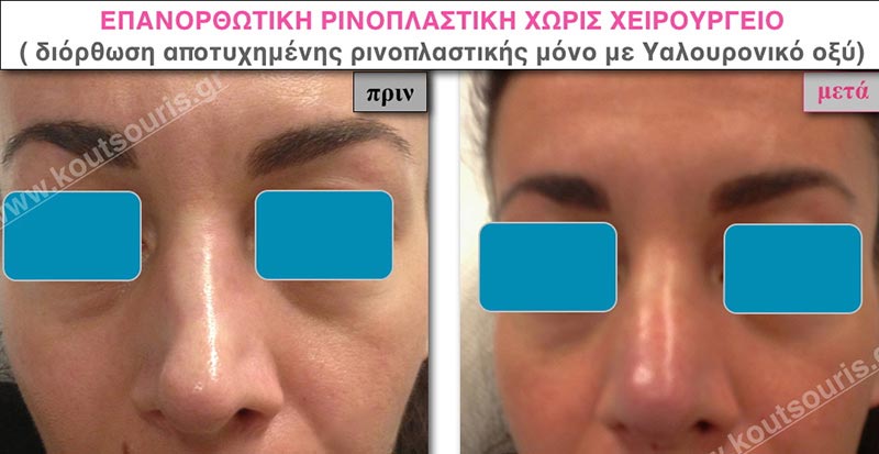 Ρινοπλαστική χωρίς χειρουργείο (Πλαστική μύτης) - Κουτσούρης