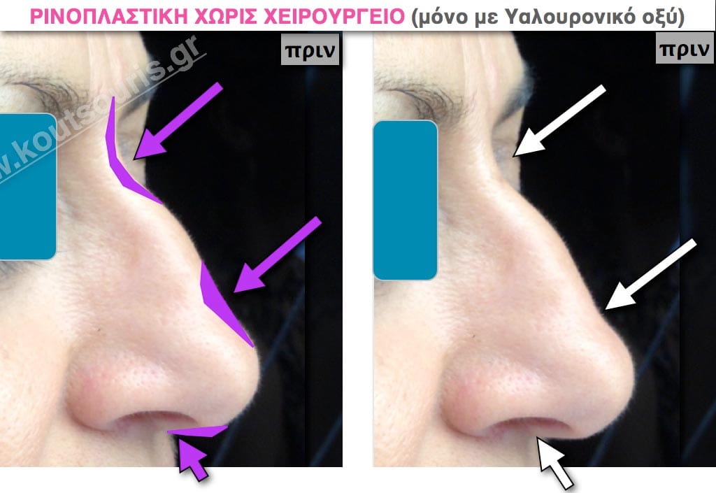 Ρινοπλαστική χωρίς χειρουργείο (Πλαστική μύτης) - Κουτσούρης