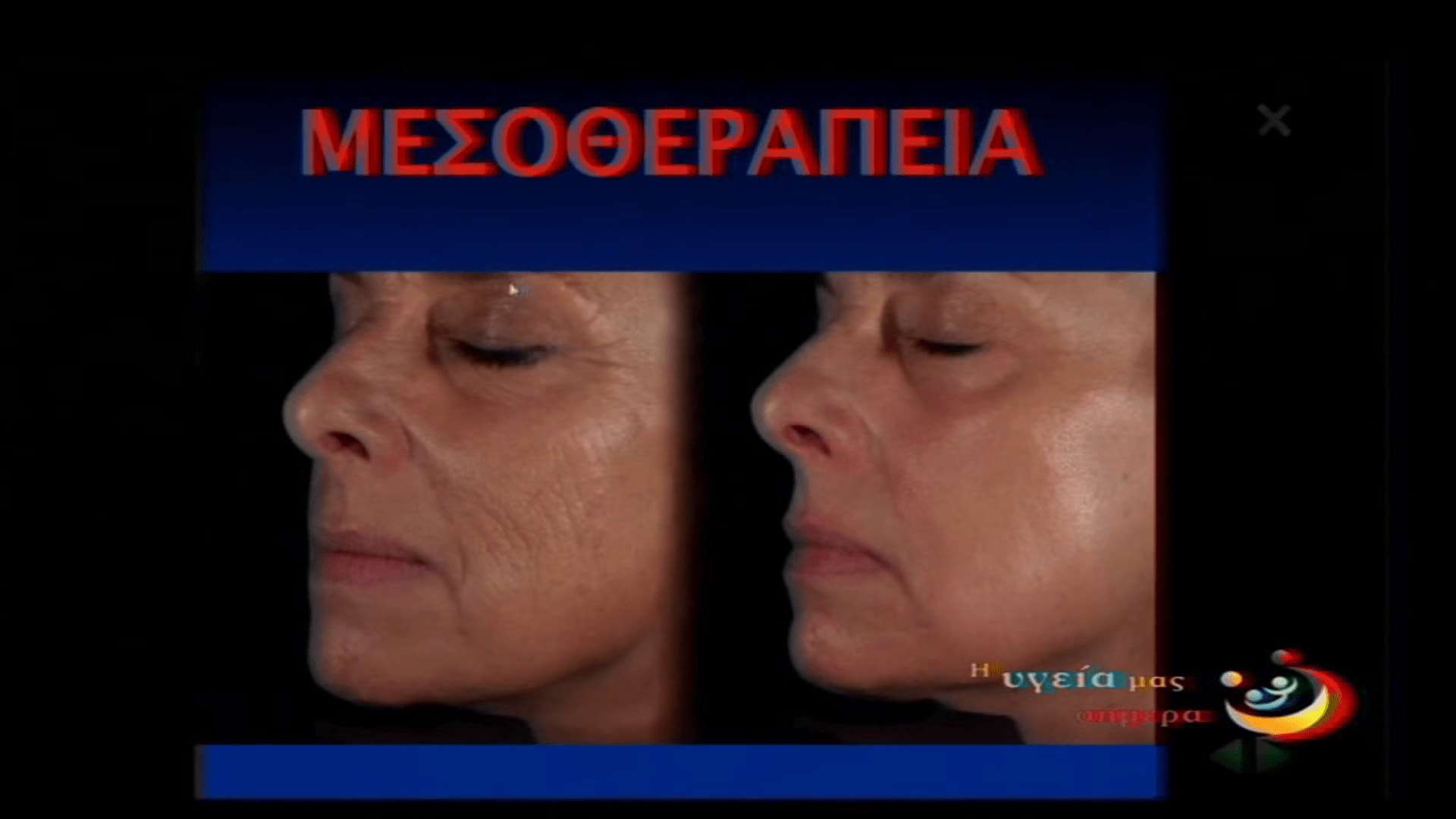 Μεσοθεραπεία - Η θεραπεία που πολεμά τις ρυτίδες