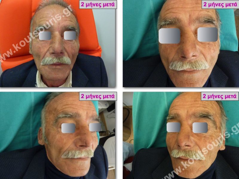 Ακανθοκυτταρικό καρκίνωμα — Μιχάλης Κουτσούρης