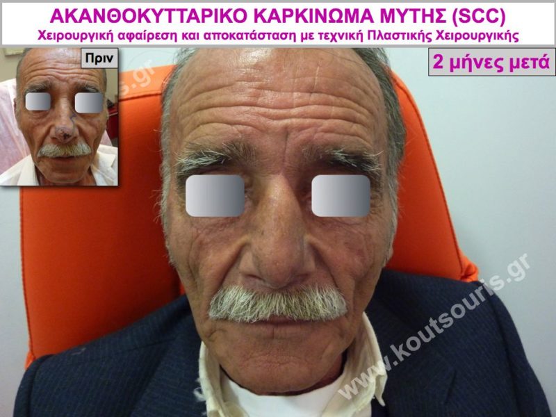 Ακανθοκυτταρικό καρκίνωμα — Μιχάλης Κουτσούρης