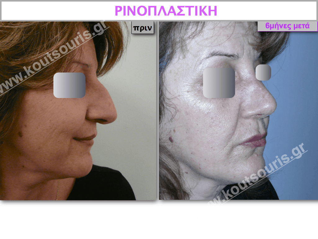 Ρινοπλαστική (Πλαστική μύτης) — Μιχάλης Κουτσούρης
