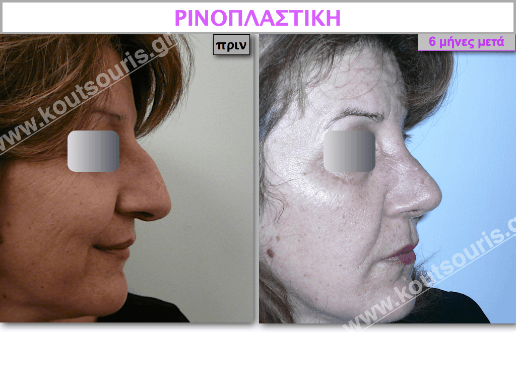 Ρινοπλαστική (Πλαστική μύτης) — Μιχάλης Κουτσούρης